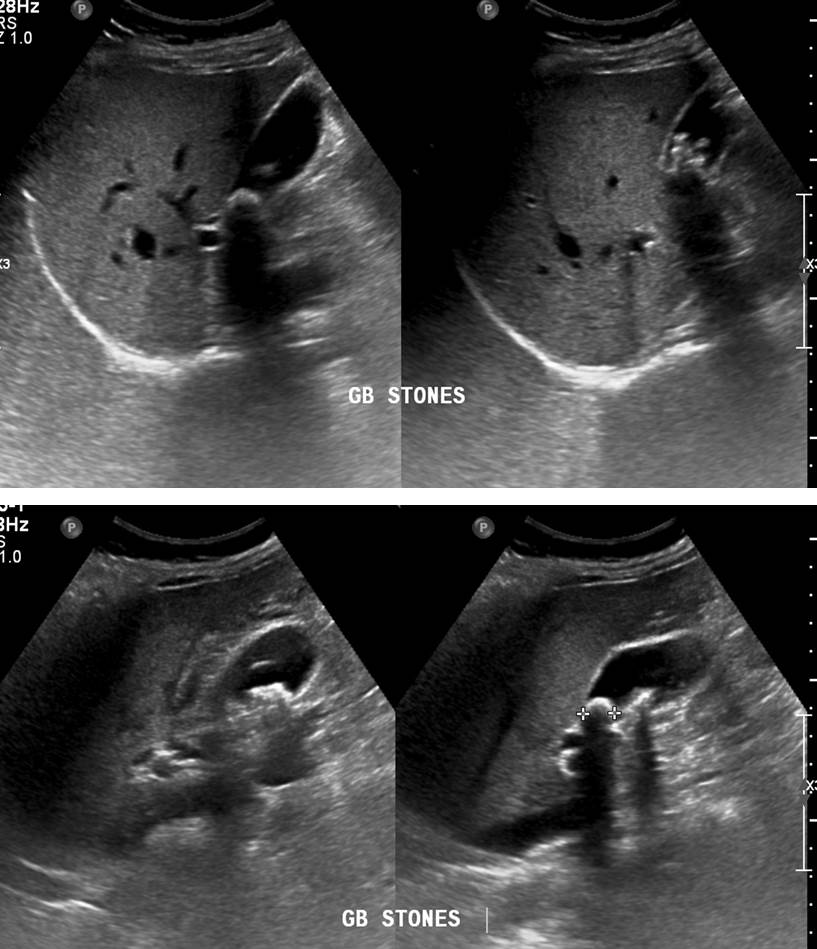 Acute appendicitis – Radiology Cases