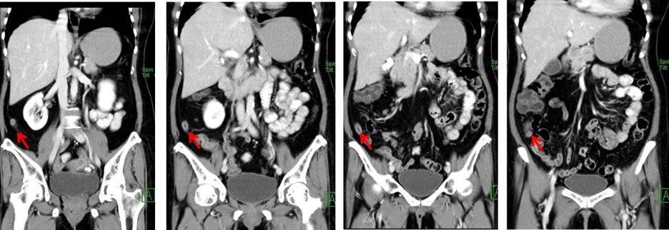 Acute appendicitis – Radiology Cases