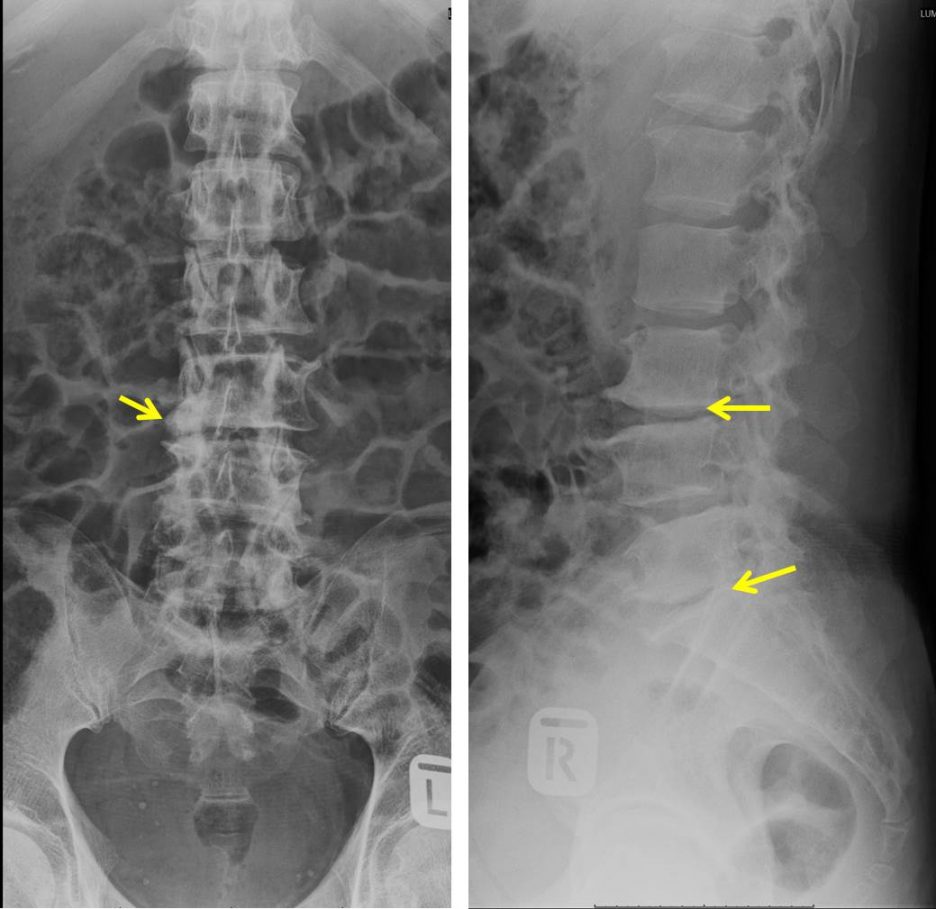 Pyogenic spondylodiscitis with paraspinal abscess – Radiology Cases