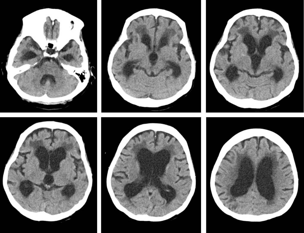 Normal pressure hydrocephalus – Radiology Cases