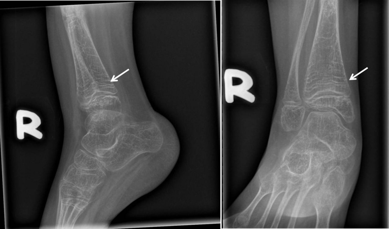 Zebra stripe sign – Radiology Cases