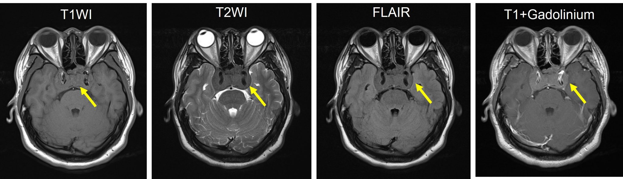 Recurrent non-functioning pituitary adenoma – Radiology Cases