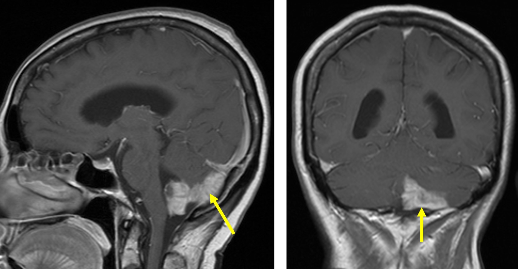 PICA infarction – Radiology Cases