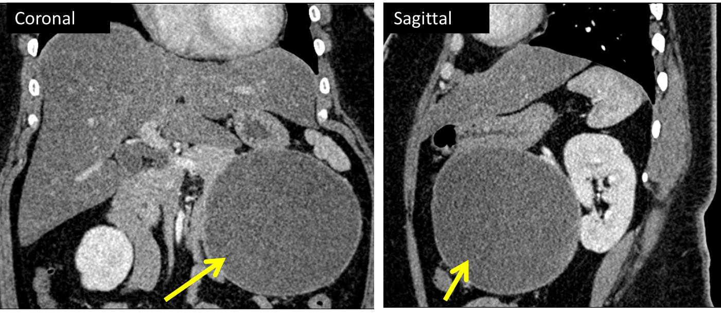 Solid pseudopapillary tumour of pancreas – Radiology Cases