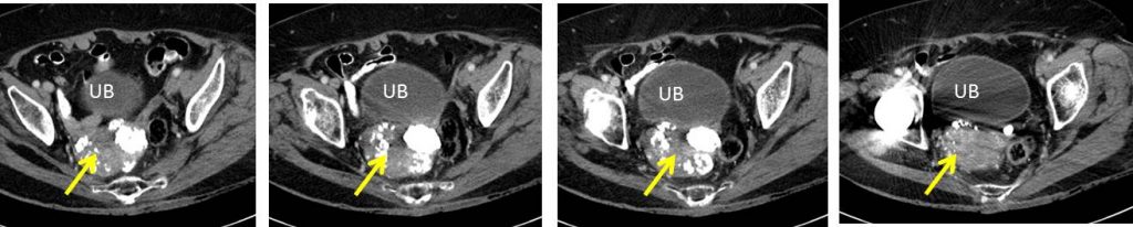 Calcified uterine fibroid – Radiology Cases