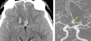 Ruptured ACOM aneurysm – Radiology Cases