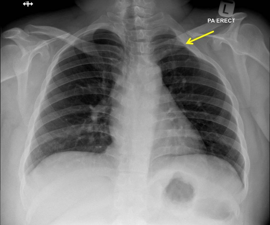 Poland syndrome – Radiology Cases