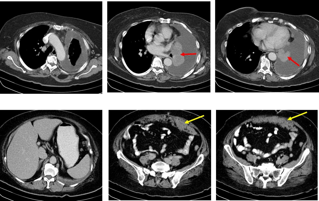 Omental cake from metastatic lung carcinoma – Radiology Cases