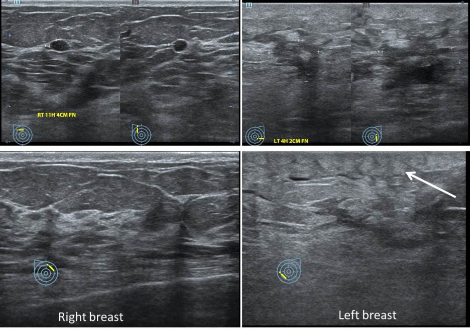Mammogram: skin thickening post radiotherapy – Radiology Cases