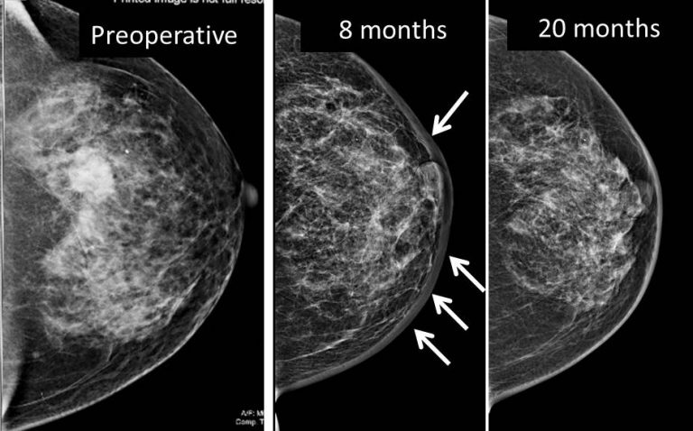 Mammogram: skin thickening post radiotherapy – Radiology Cases