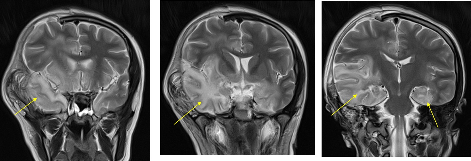 Herpes simplex encephalitis – Radiology Cases