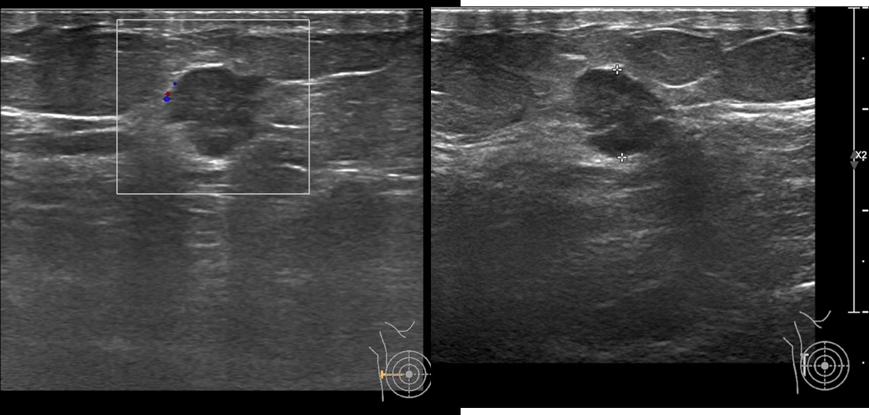 Tomosynthesis in fatty breasts – Radiology Cases