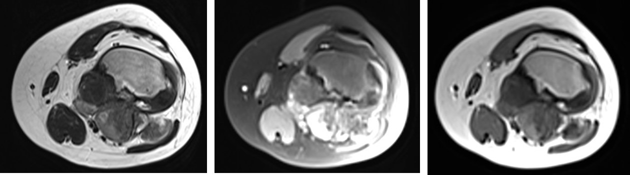 Parosteal osteosarcoma – Radiology Cases