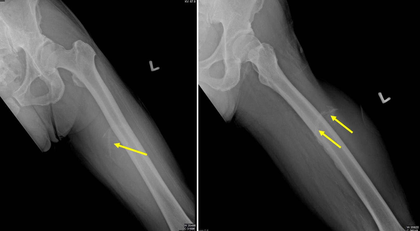 Extraskeletal osteosarcoma – Radiology Cases