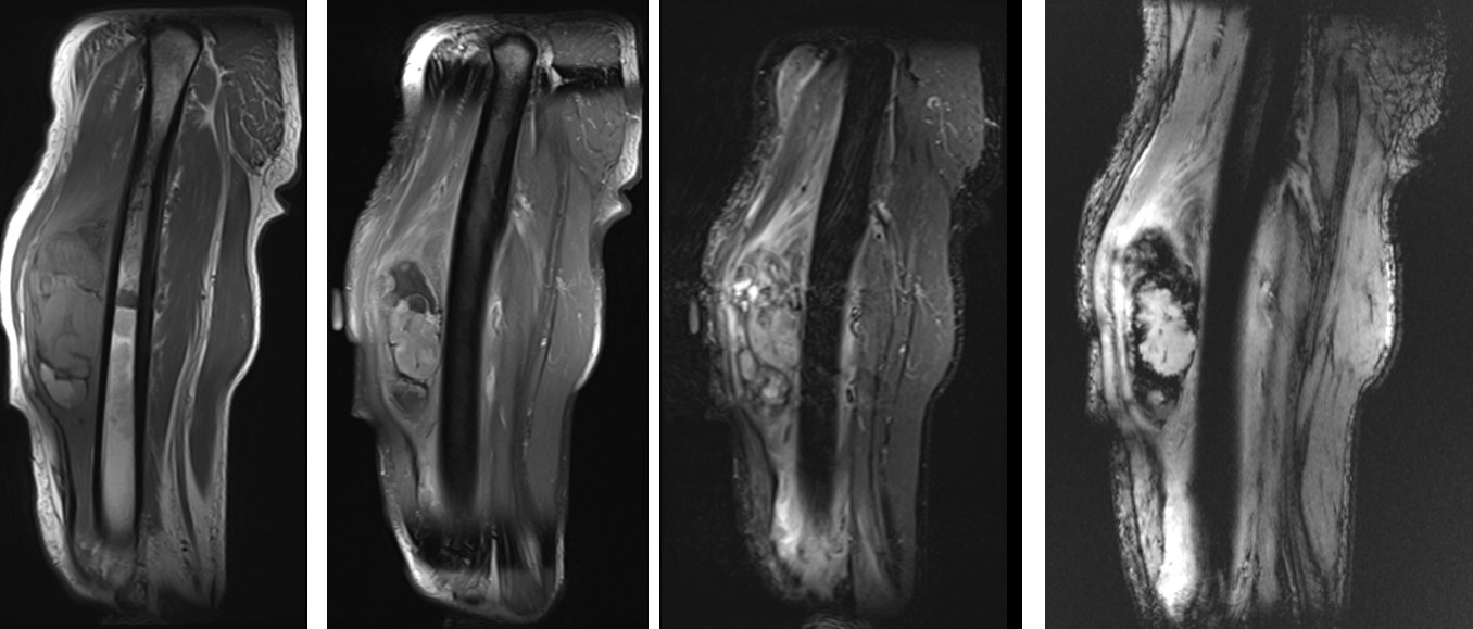 Extraskeletal osteosarcoma – Radiology Cases