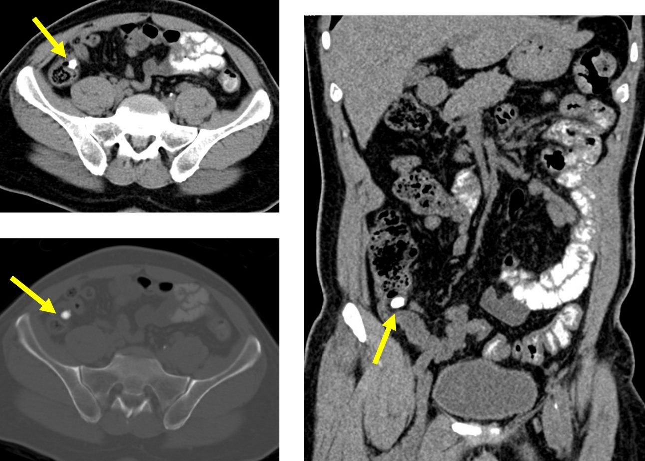 Appendicolith – Radiology Cases