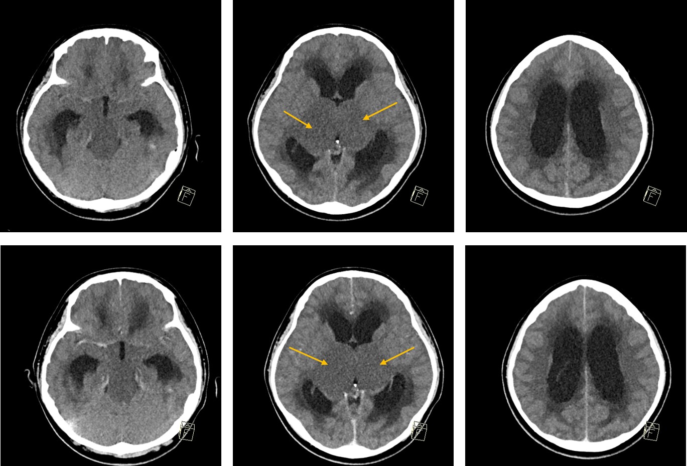 Bilateral thalamic glioma – Radiology Cases