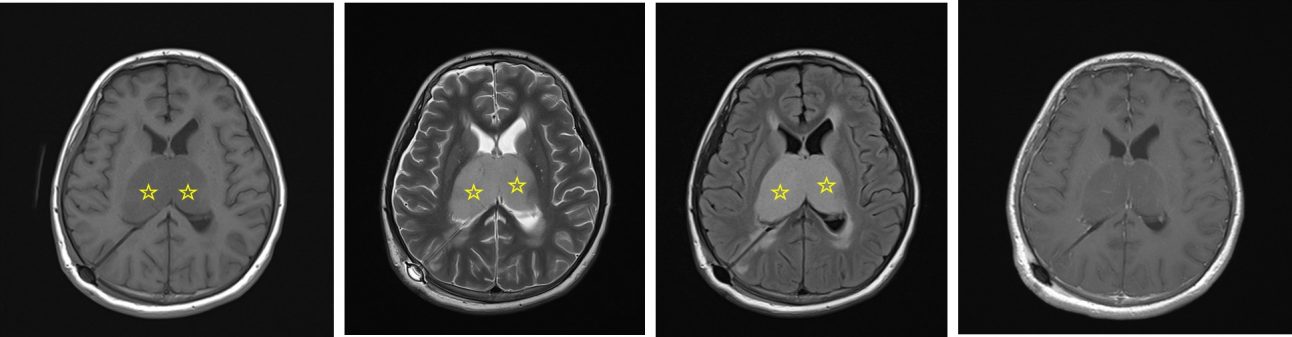 Bilateral thalamic glioma – Radiology Cases