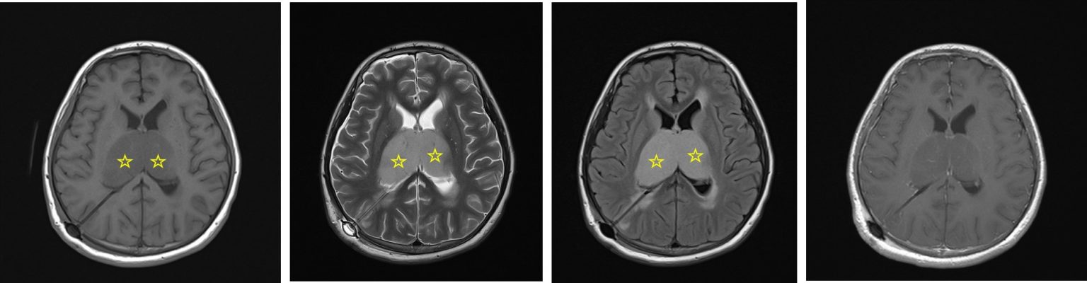 Bilateral thalamic glioma – Radiology Cases